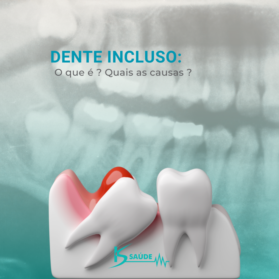 O que são Dentes Inclusos? - kssaude.com.br